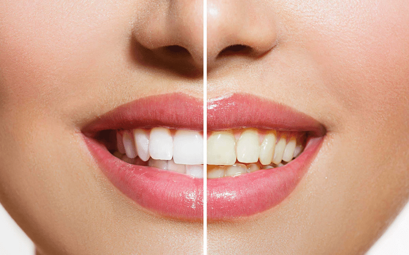 Yellow Teeth? Here’s How to Whiten Your Smile Fast